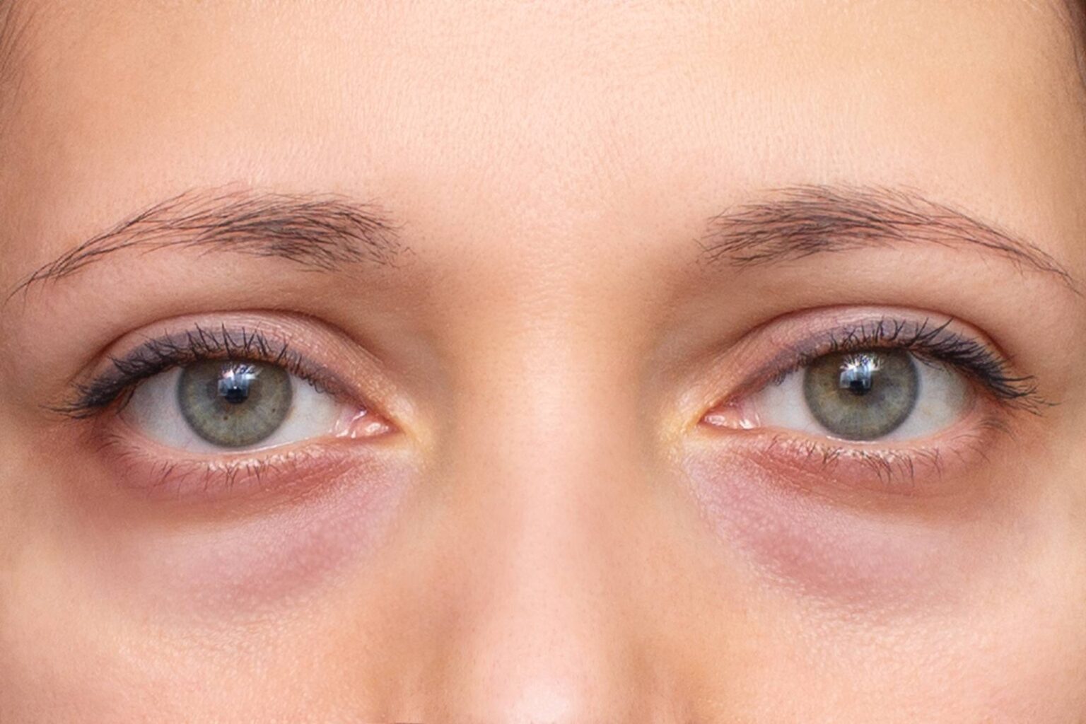 What Causes Under-Eye Bags & How Can You Get Rid of Them?